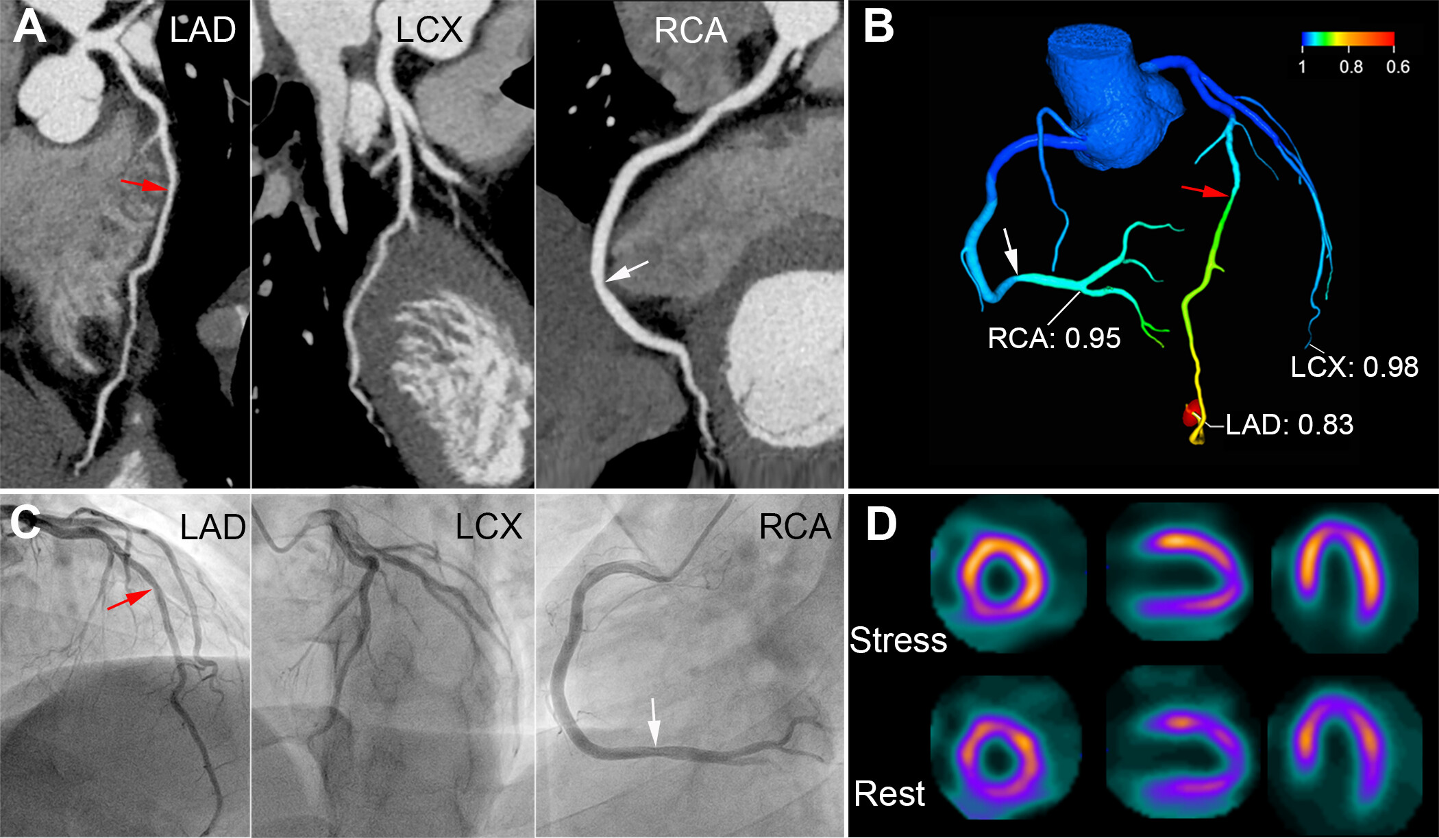 CT-QFR在冠心病患者长期随访中的预测价值研究结果在Radiology发表[1]_上海交通大学CIIIC实验室